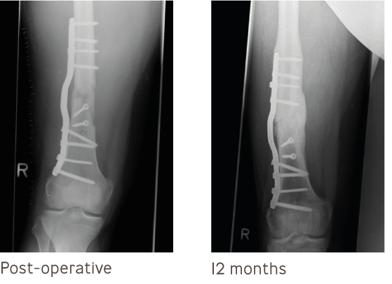 NanoBone® Fully Synthetic Bone Graft Substitute | Biocomposites